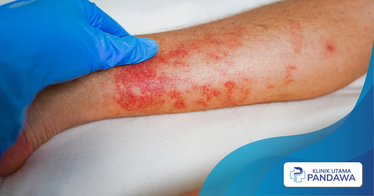 Gatal Herpes Tak Tertahankan? Jangan Garuk! Lakukan Ini! - Klinik Utama ...