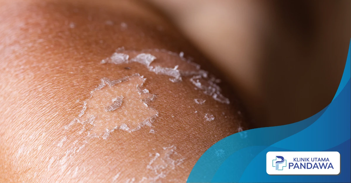 Kulit Tangan Mengelupas: Penyebab, Cara Mengatasi, dan Pencegahannya ...