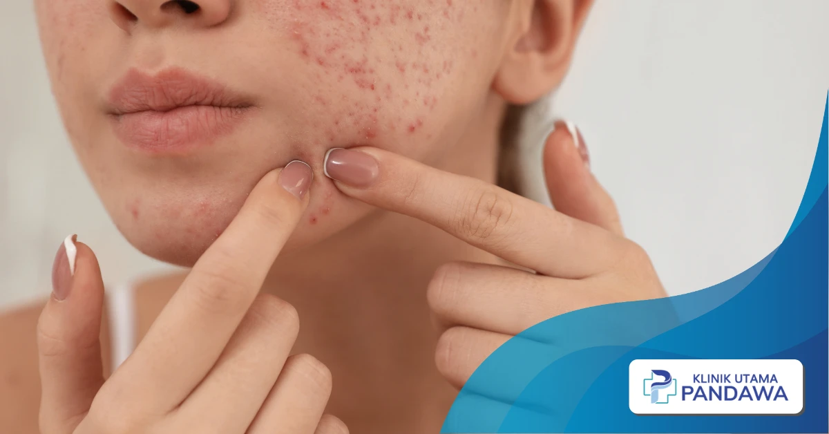 Perbedaan Jerawat dan Bruntusan: Penyebab, Ciri-Ciri, dan Cara Mengatasinya - Klinik Utama Pandawa