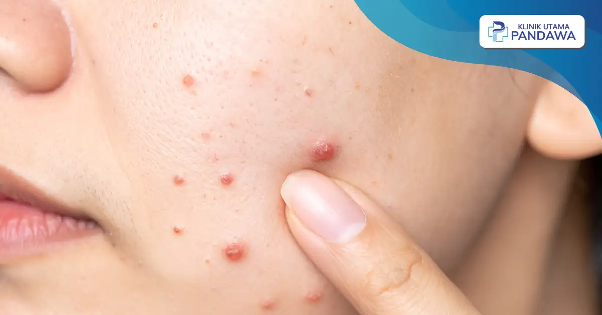 Jerawat atau Bruntusan? Ini Bedanya yang Wajib Kamu Tahu! - Klinik Utama Pandawa