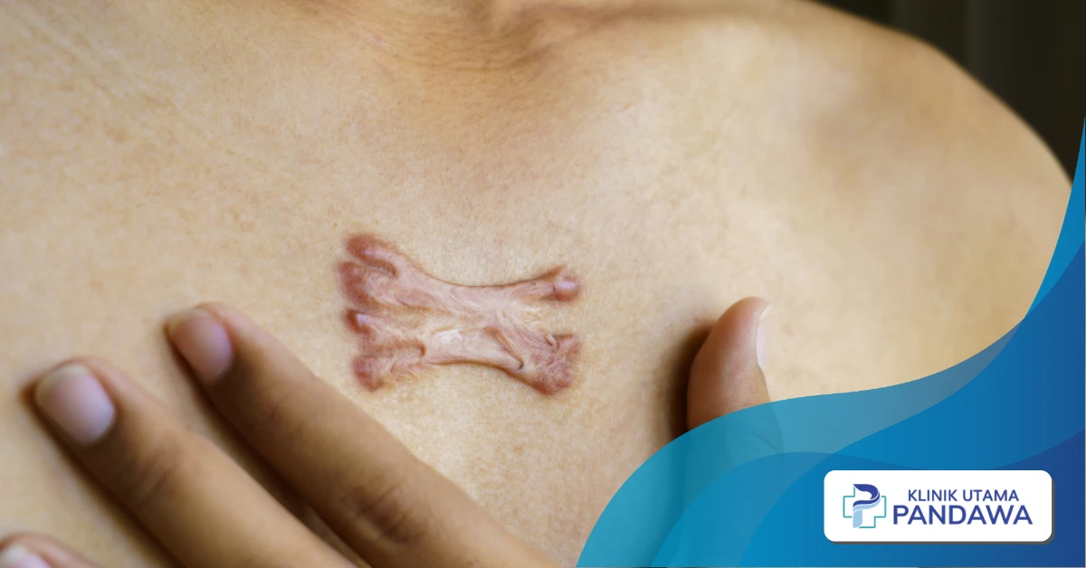 Apakah Keloid Berbahaya? Kenali Penyebab, Dampak, dan Cara ...