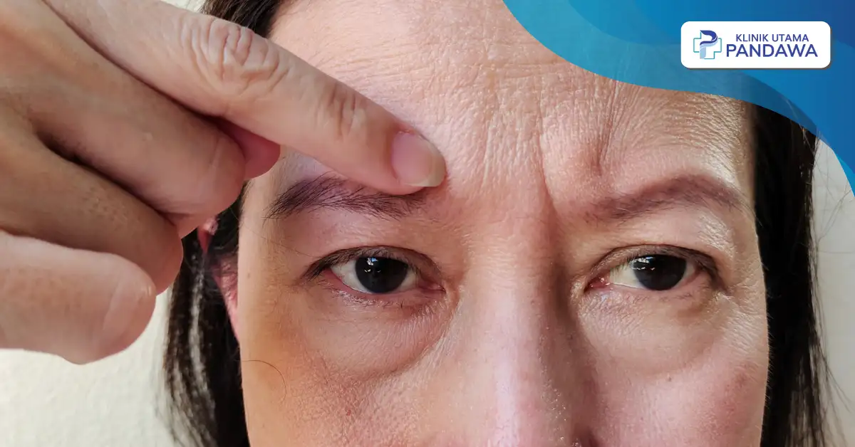 Lentigo atau Melasma? Kenali Bedanya Sekarang! - Klinik Utama Pandawa