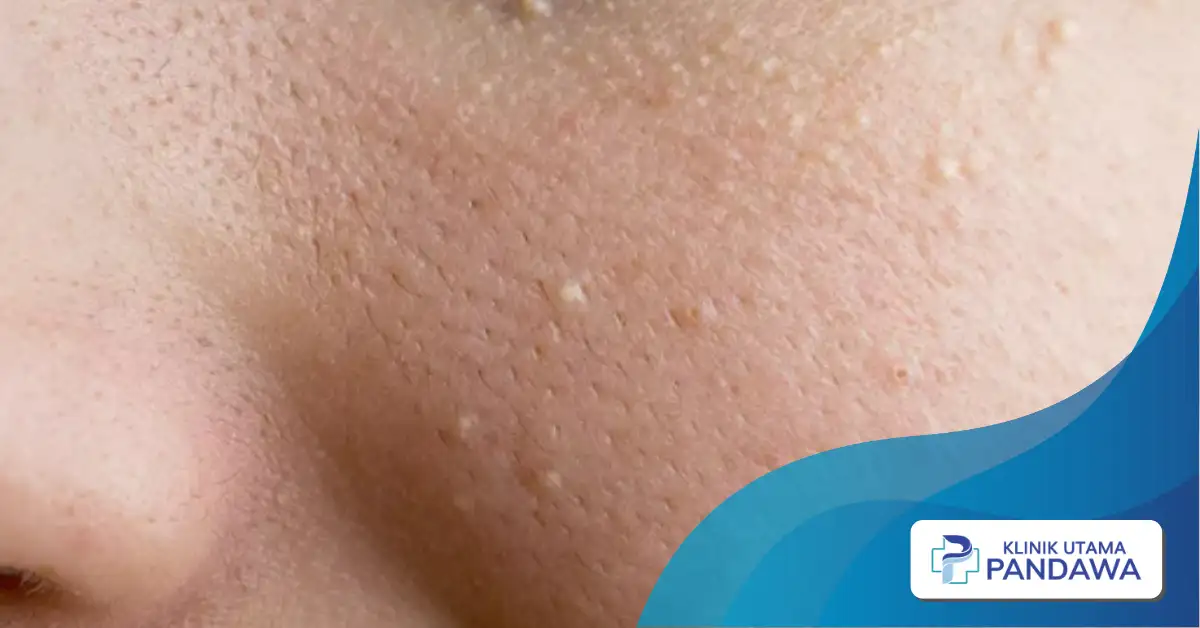 Wajah Muncul Bintik Putih? Ini Penjelasan dan Solusinya! - Klinik Utama Pandawa