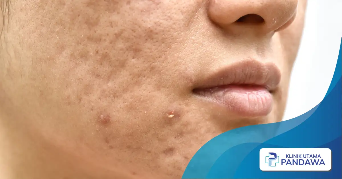 Jerawat Mendem: Kenali Penyebab dan Cara Ampuh Mengatasinya! - Klinik ...